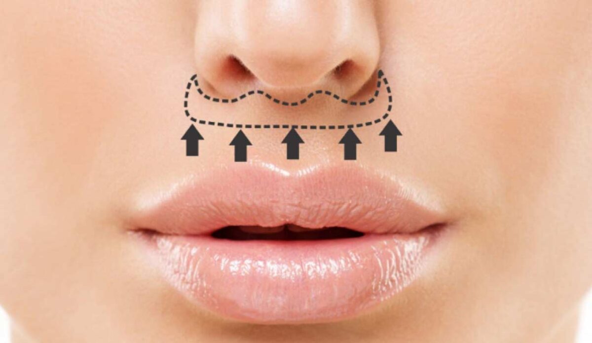 Lip Lift | Quartz Surgical Hospital